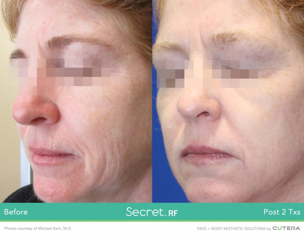 Radio Frequency Micro-Needling - Skin Hout Bay